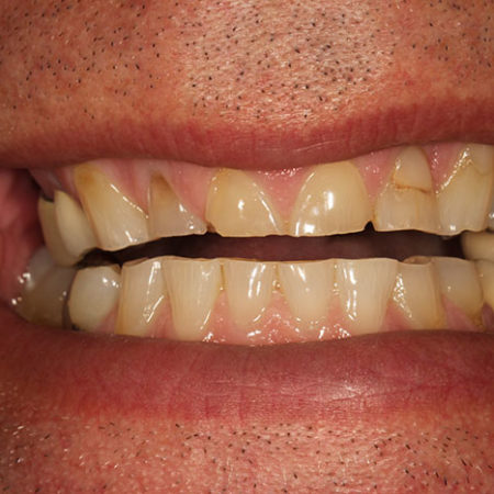 What are Splayed Teeth? Front Teeth With Outward Inclination